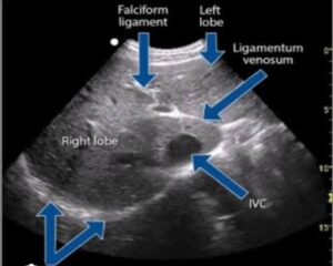 Introduction To Liver Sonography Ultrasound Simplified